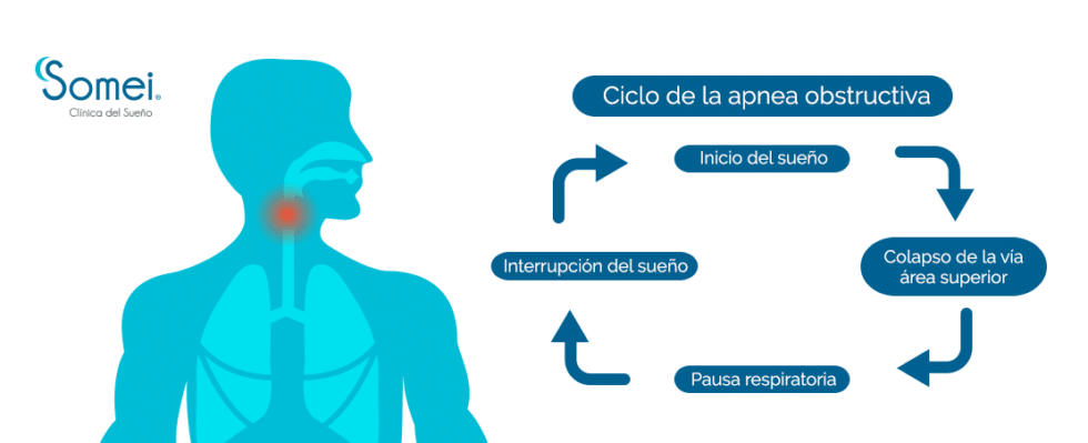Apnea del sueño - Somei : Clínica del Sueño